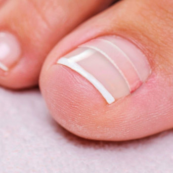 Nagelbeugel plaatsen – pedicuresalon Elly de Vries